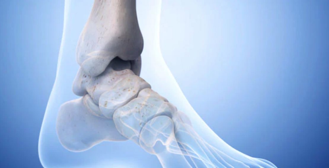 FDA Warning Issued for Premature STAR Ankle Failures